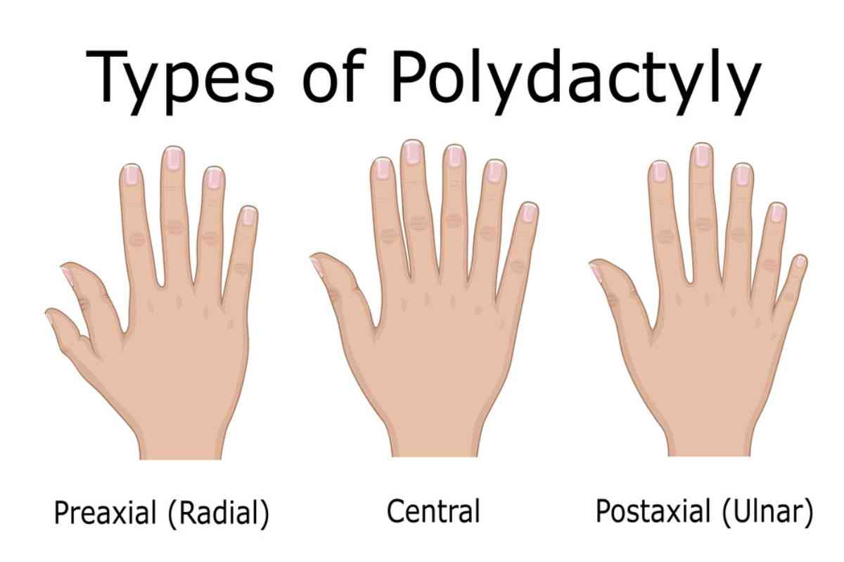 12 Spiritual Meanings of Having 6 Fingers (Polydactyly)
